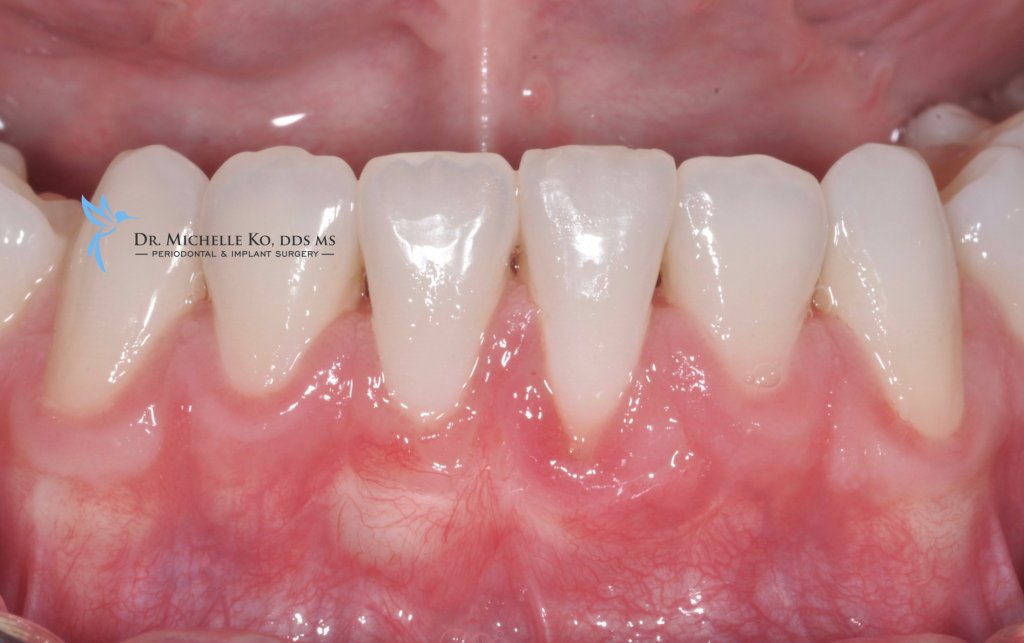 Frenectomy Bellevue Wa Frenum Removal Surgery
